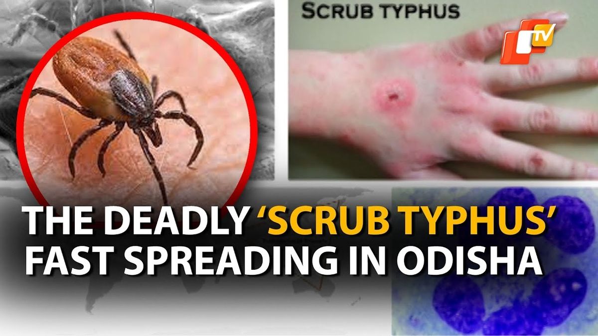 Scrub Typhus Outbreak: A Growing Concern in Odisha