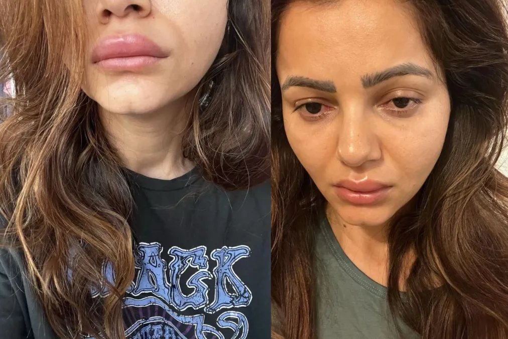 Rubina Dilaik shares pictures with swollen lips and puffed face ...