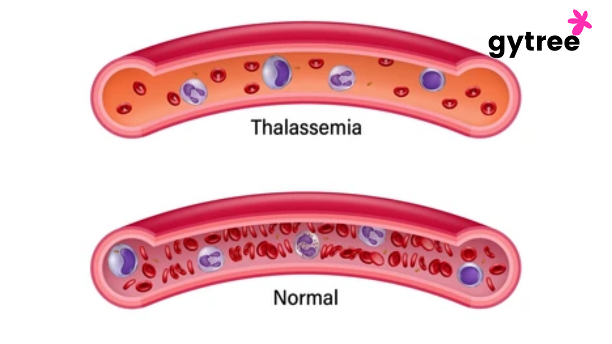 Thalassemia- a lesser known but deadly disease