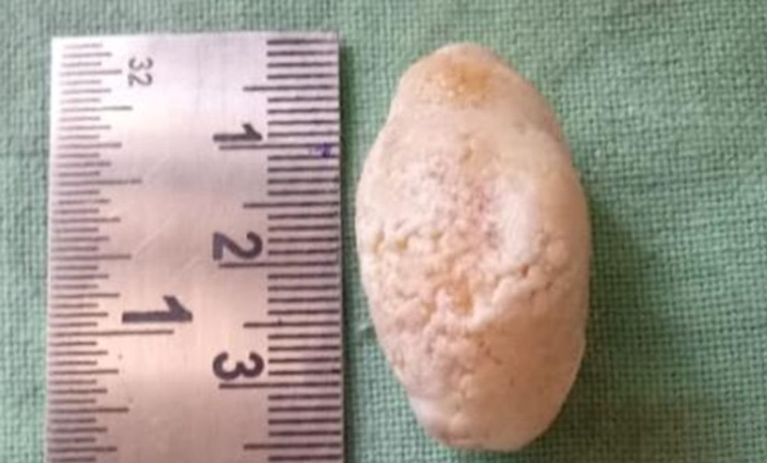 ഉമിനീര്‍ ഗ്രന്ഥിയില്‍നിന്നു നാല് സെന്റിമീറ്ററോളം വലുപ്പമുള്ള കല്ല് ...