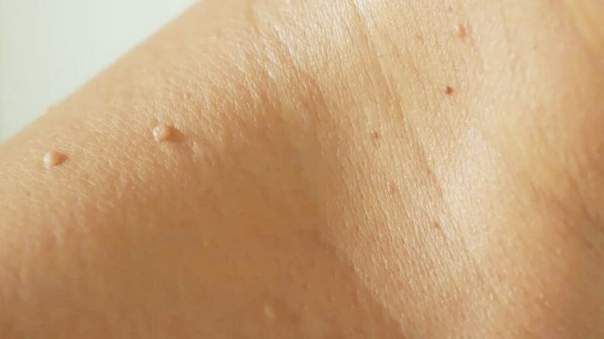 സ്കിൻ ടാഗുകൾ എങ്ങനെ സുരക്ഷിതമായി നീക്കം ചെയ്യാം?