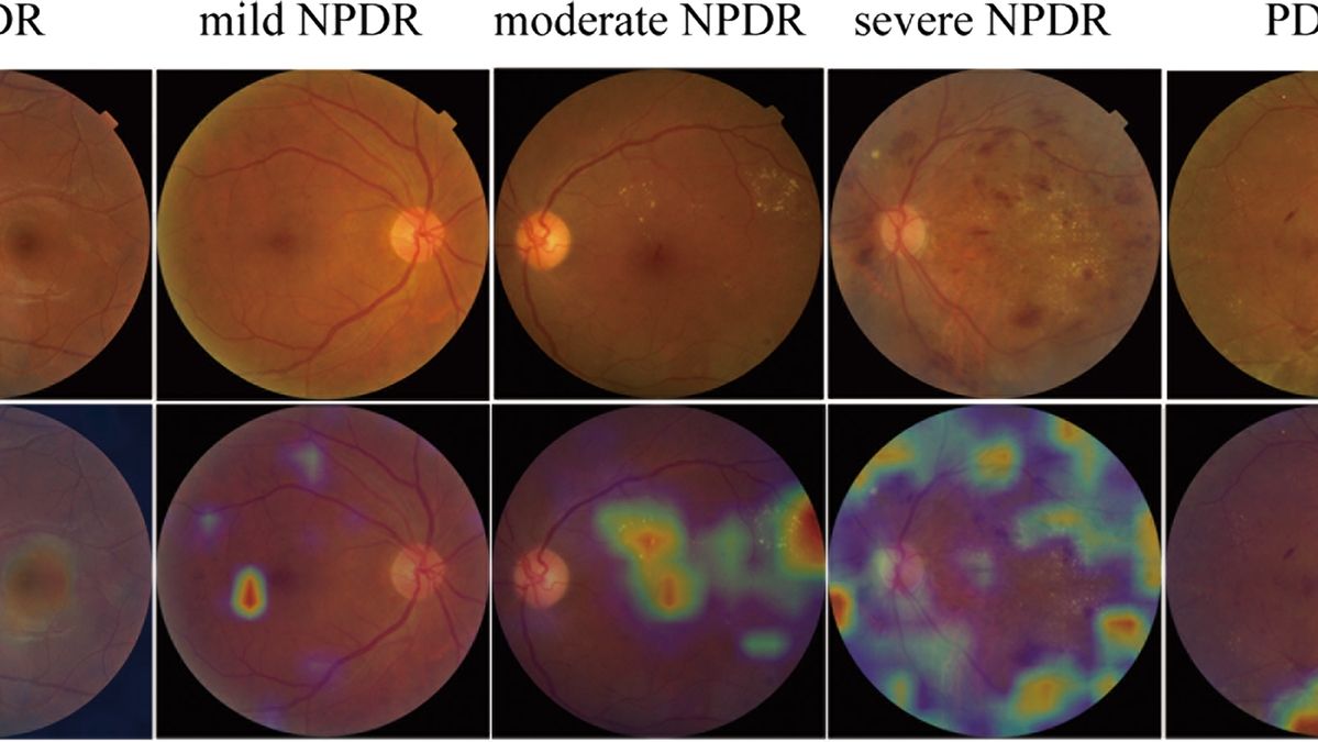 Leveraging Artificial Intelligence to Improve Diabetic Retinopathy Screening
