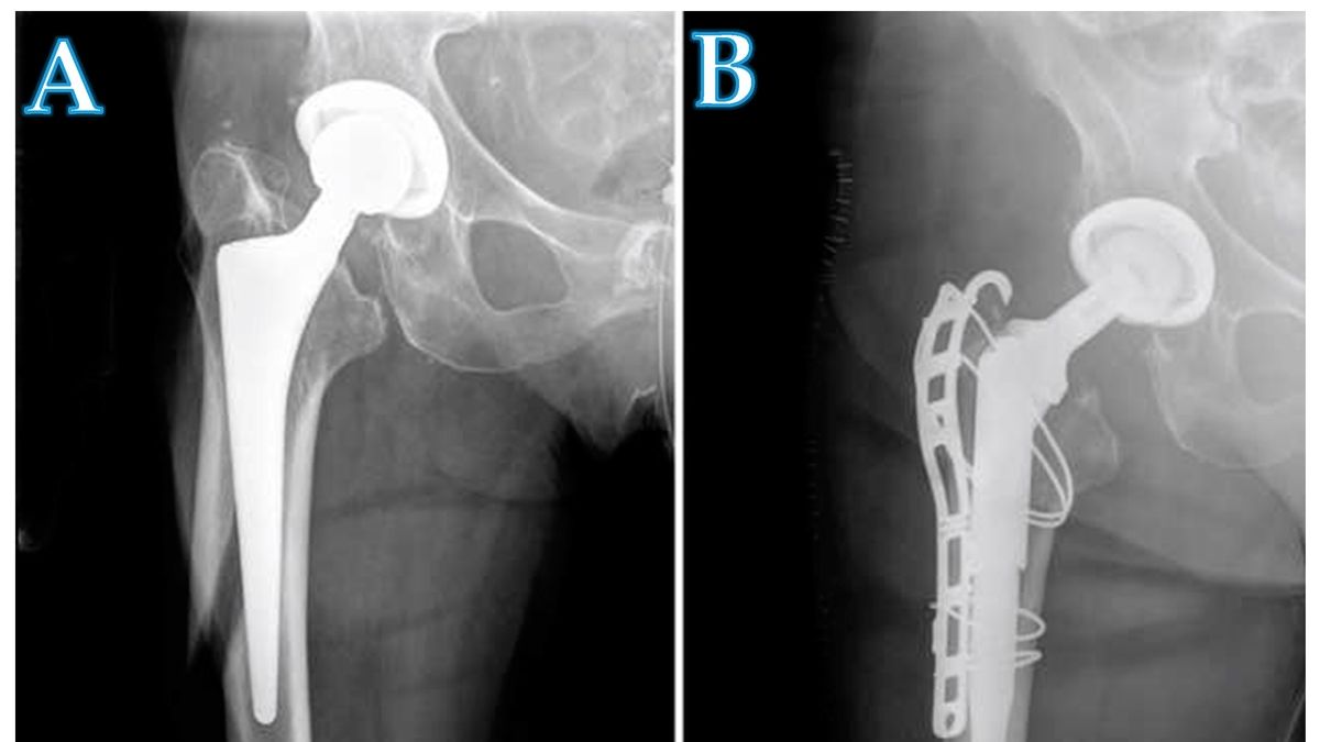 Modular Cemented Stems: A Viable but Risky Treatment Option for Revision Total Hip Arthroplasty