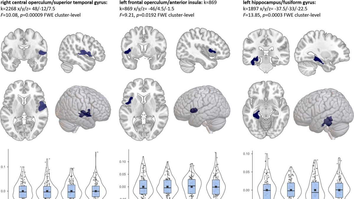 Understanding Early Onset Psychosis: Link to Gray Matter Reduction ... Understanding Early Onset Psychosis: Link to Gray Matter Reduction ...