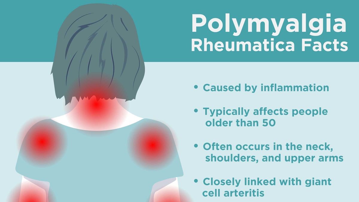 Understanding Polymyalgia Rheumatica: A Comprehensive Overview