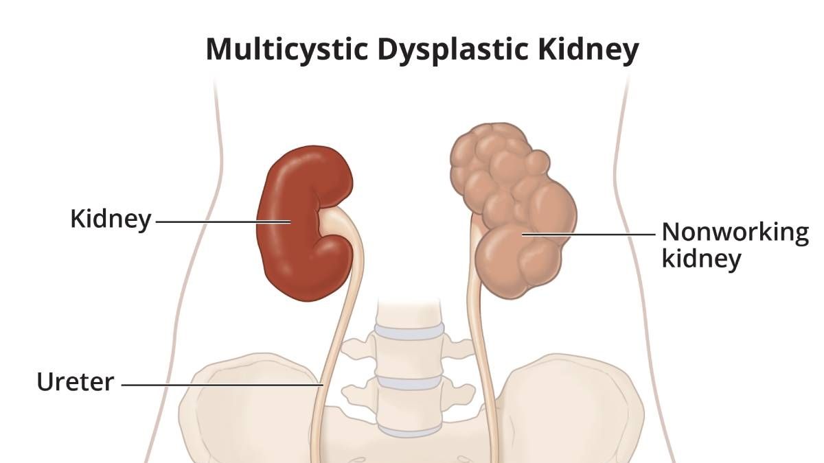 Understanding Prenatal Characteristics and Adverse Neonatal Outcomes of Multicystic Dysplastic ...