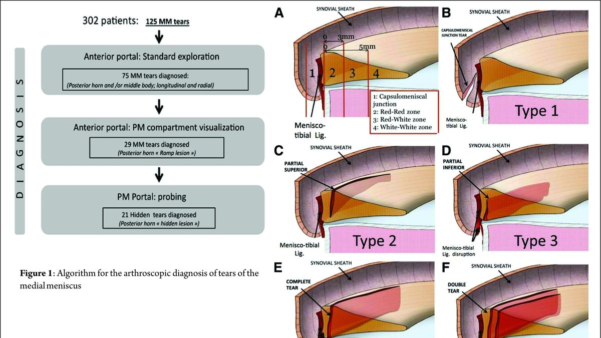 Addressing Ramp Lesions: A Comprehensive Approach to Enhancing Knee ...