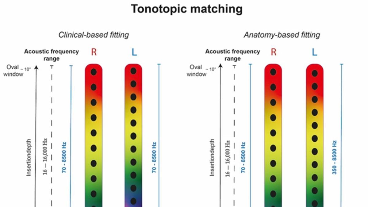 Understanding the Tonal Presentation in Cochlear Implants: The ...