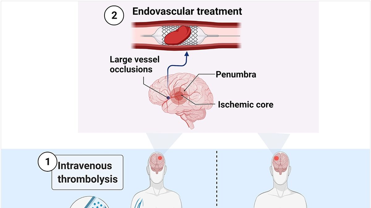The Importance of Early Intravenous Thrombolysis in Acute Ischemic Stroke