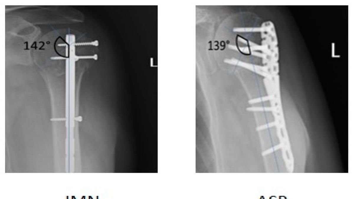 Comparing Locking Nails And Locking Plates In The Treatment Of Proximal Humerus Fractures An