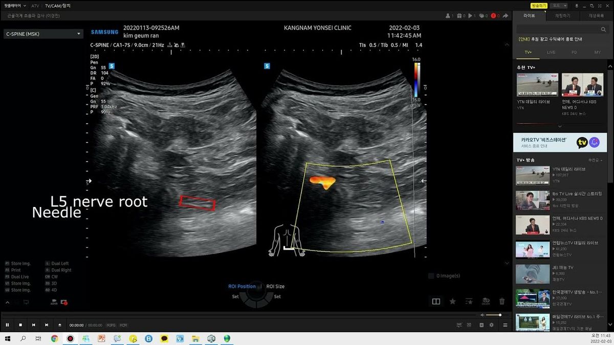 Ultrasound Guided Versus Fluoroscopy Guided Lumbar Selective Nerve Root