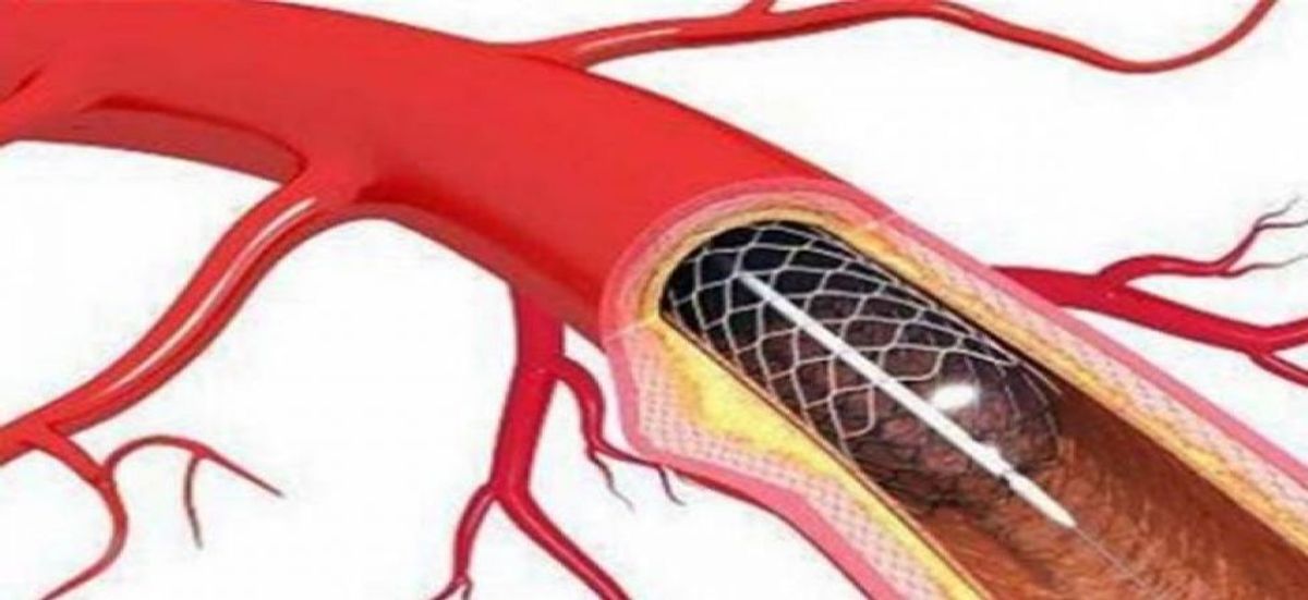 World’s smallest stent developed by scientists World’s smallest stent developed by scientists