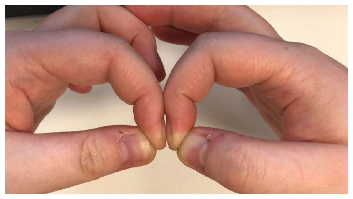 Simple â€˜Diamond Gapâ€™ Finger Test May Help Detect Lung Cancer
