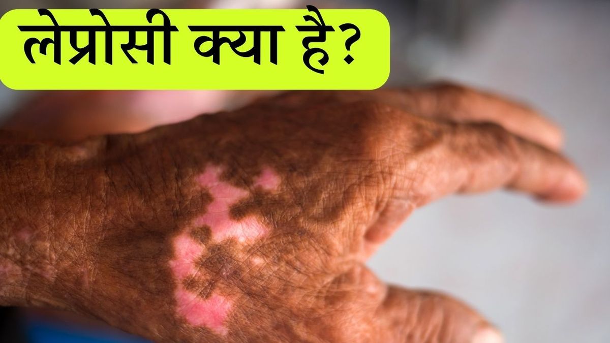 Leprosy Disease: लेप्रोसी क्या है जानें इसके कारण, लक्षण और इलाज