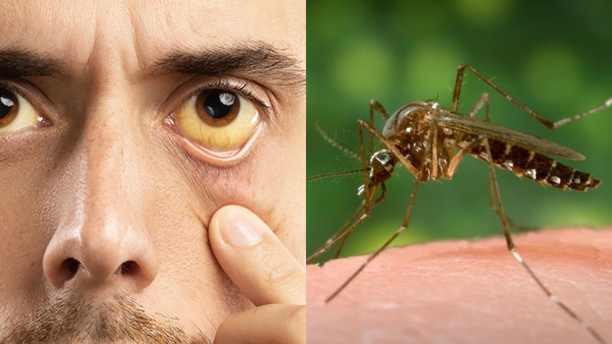 Yellow Fever:ఎల్లో ఫీవర్‌ అంటే ఏమిటి? ఈ జ్వరం లక్షణాలు, కారణాలు ఏంటో ...