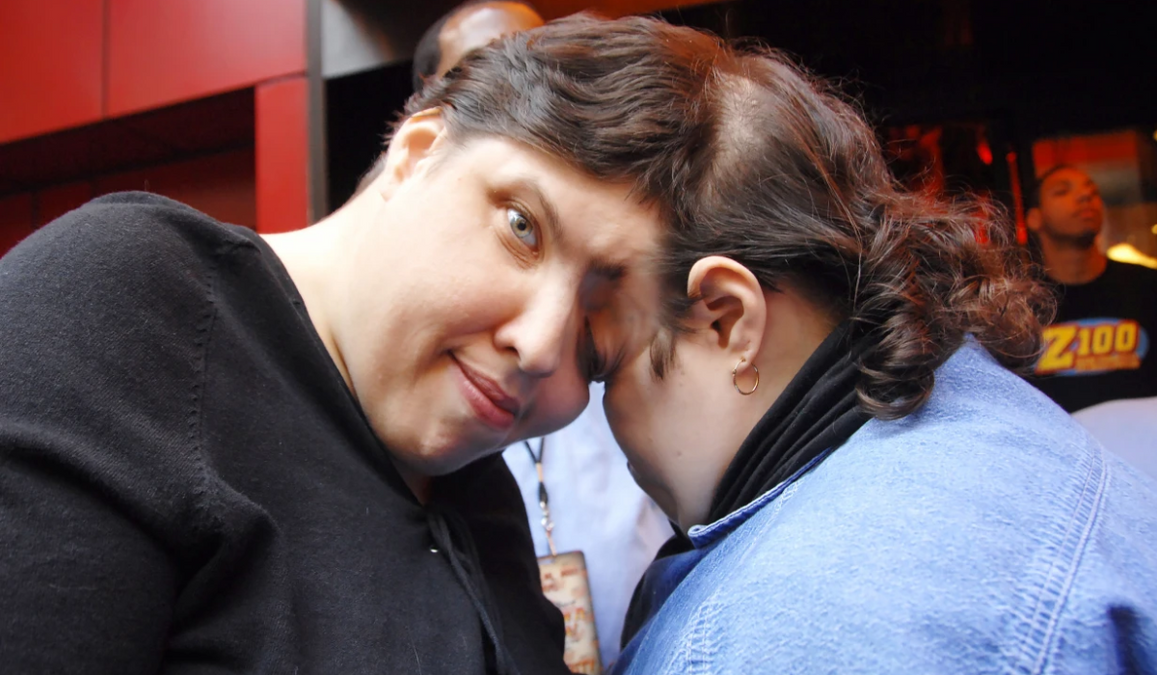 Who Were Lori and George Schappell? World's Oldest Conjoined Twins Die ...