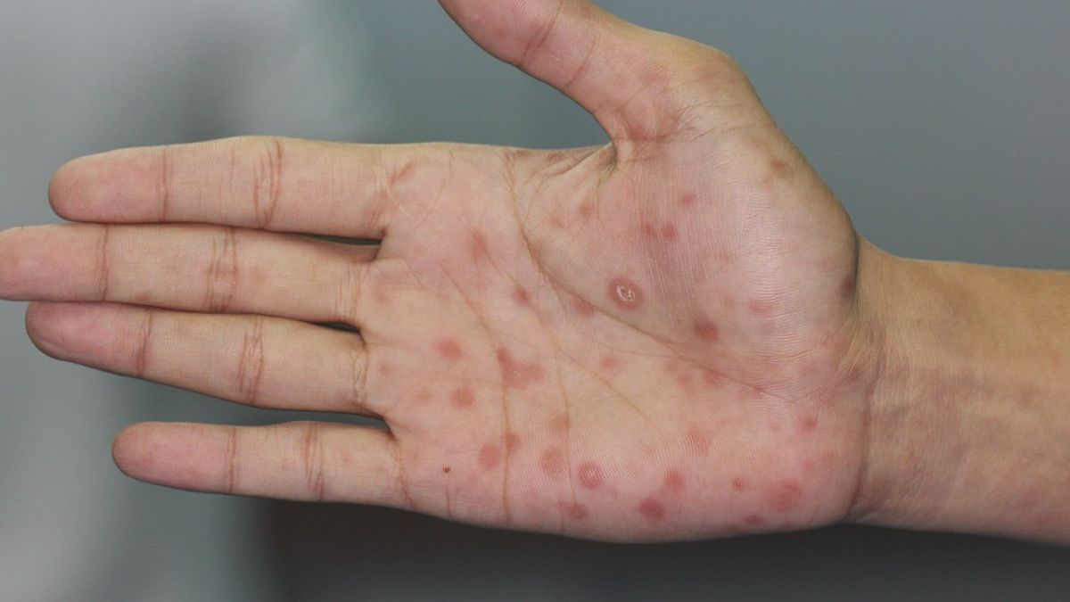 Explainer: Rising cases of syphilis in the US: What is this stigmatised ...