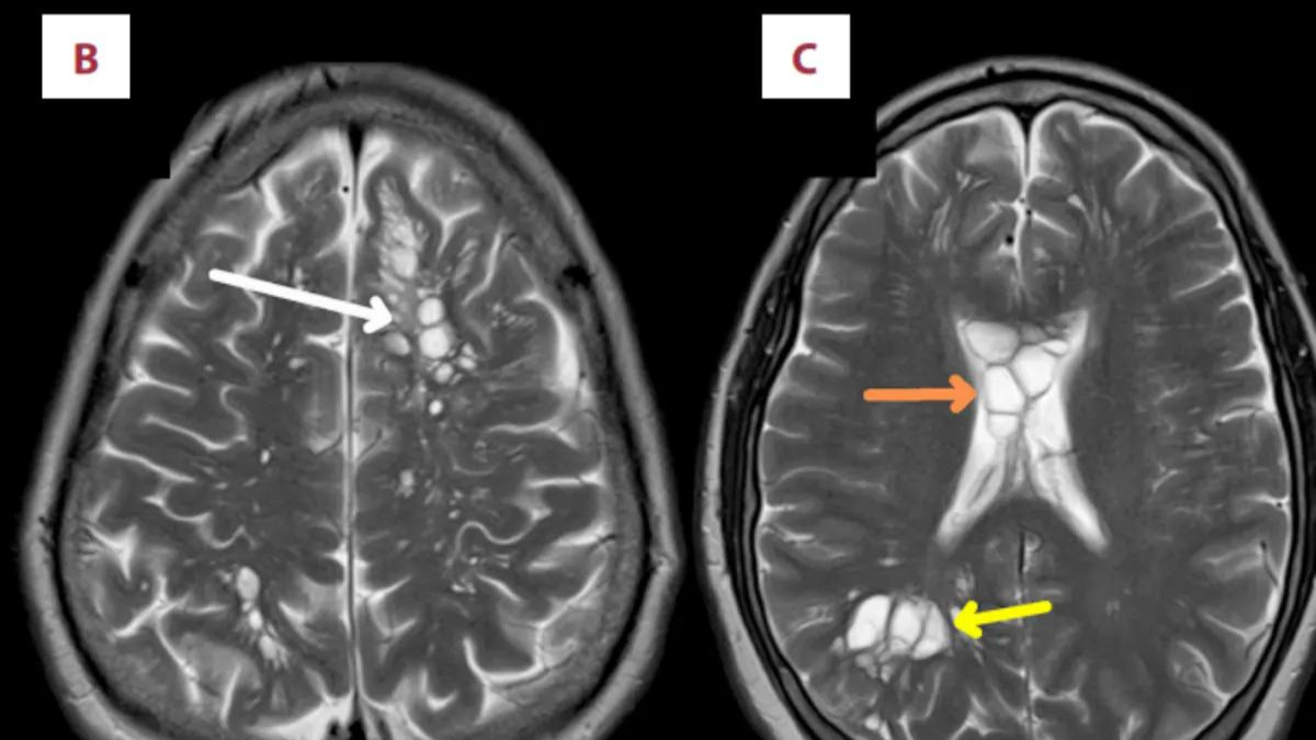 Tapeworms in brain! Here's how parasitic worms infested a man's brain in US