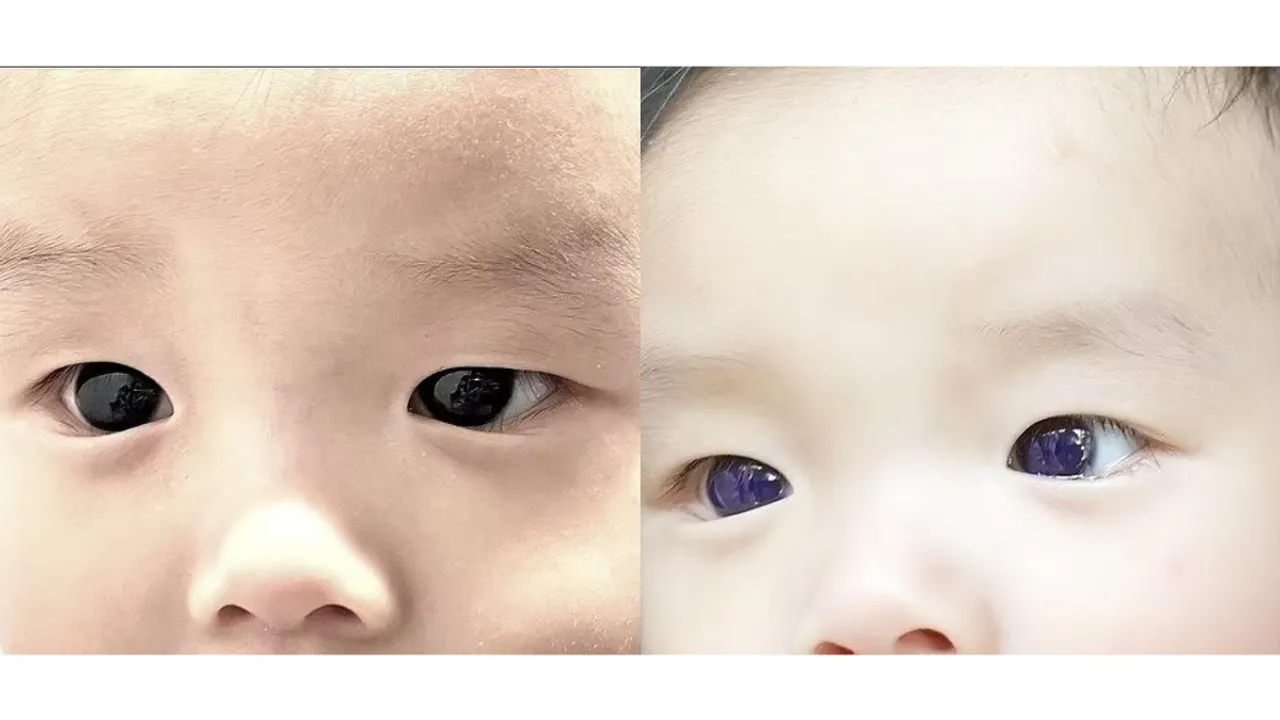 Infant's eye colour changes from dark brown to bright blue after COVID ...