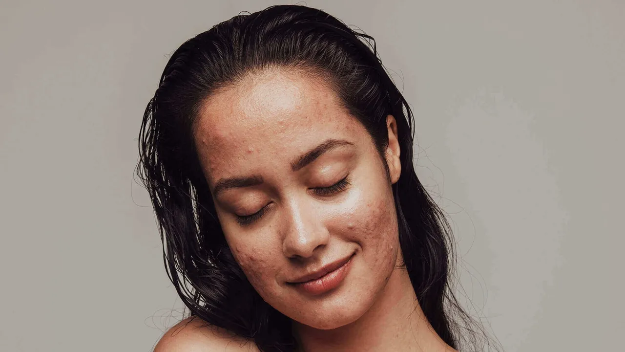 Conquering Forehead Acne: Dr. Aanchal Panth's Essential Guide