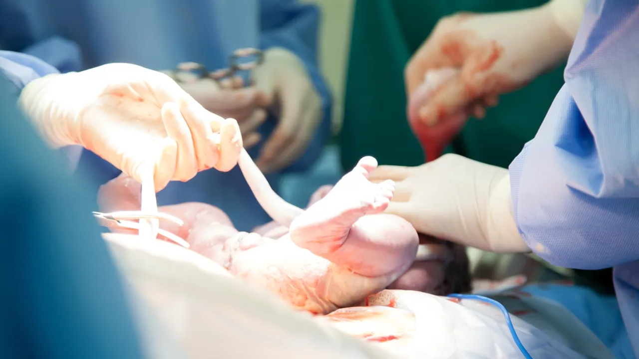 Delaying Umbilical Cord Clamping Boosts Survival Rates in Preterm ...