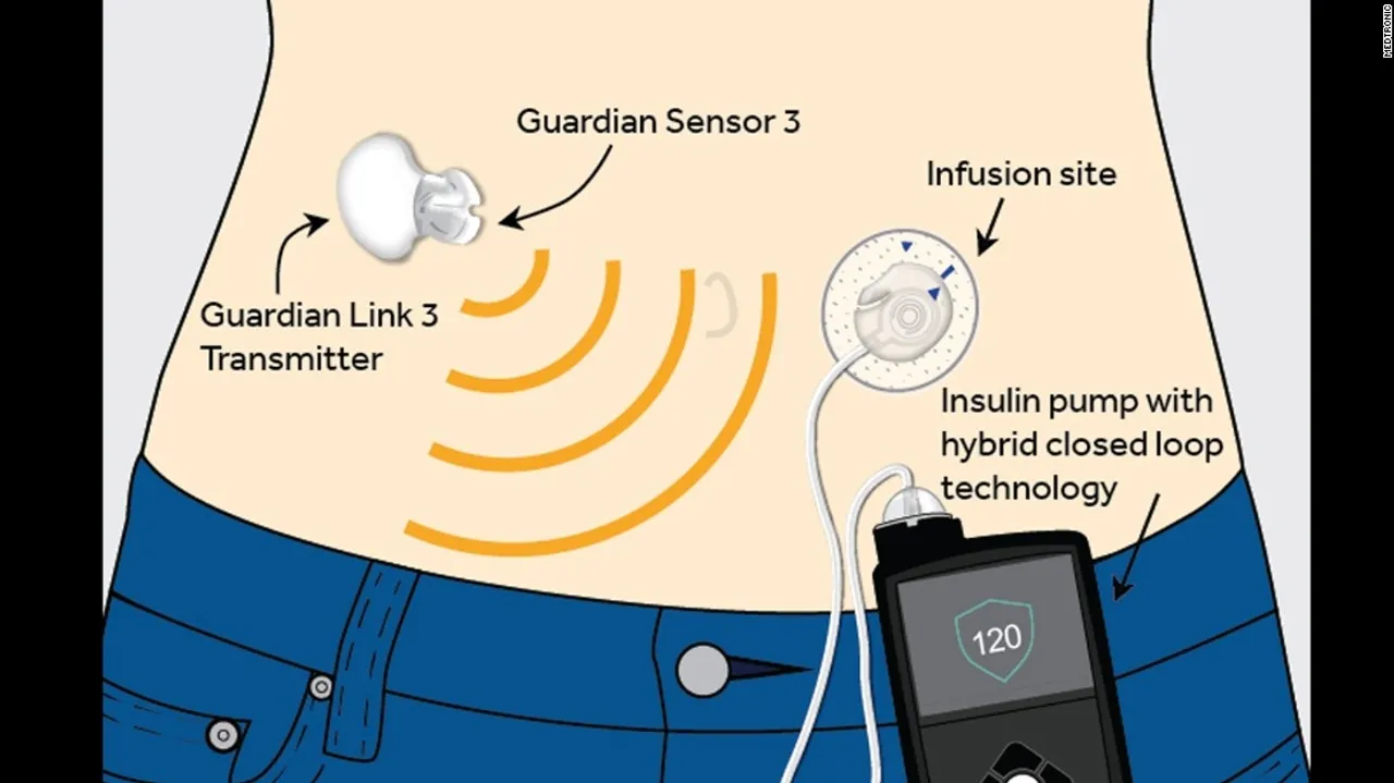 Breakthrough Artificial Pancreas System Promises Revolution in Type 1 ...