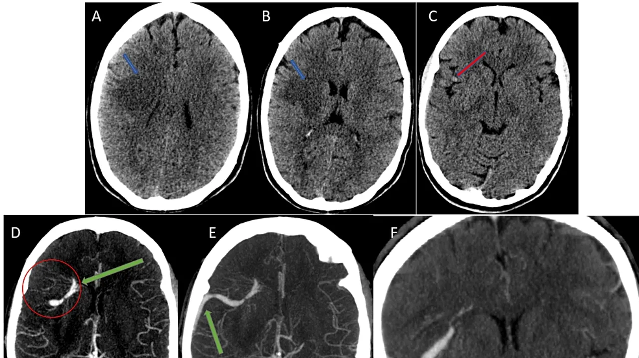 Developmental Venous Anomaly: A Stroke Mimic