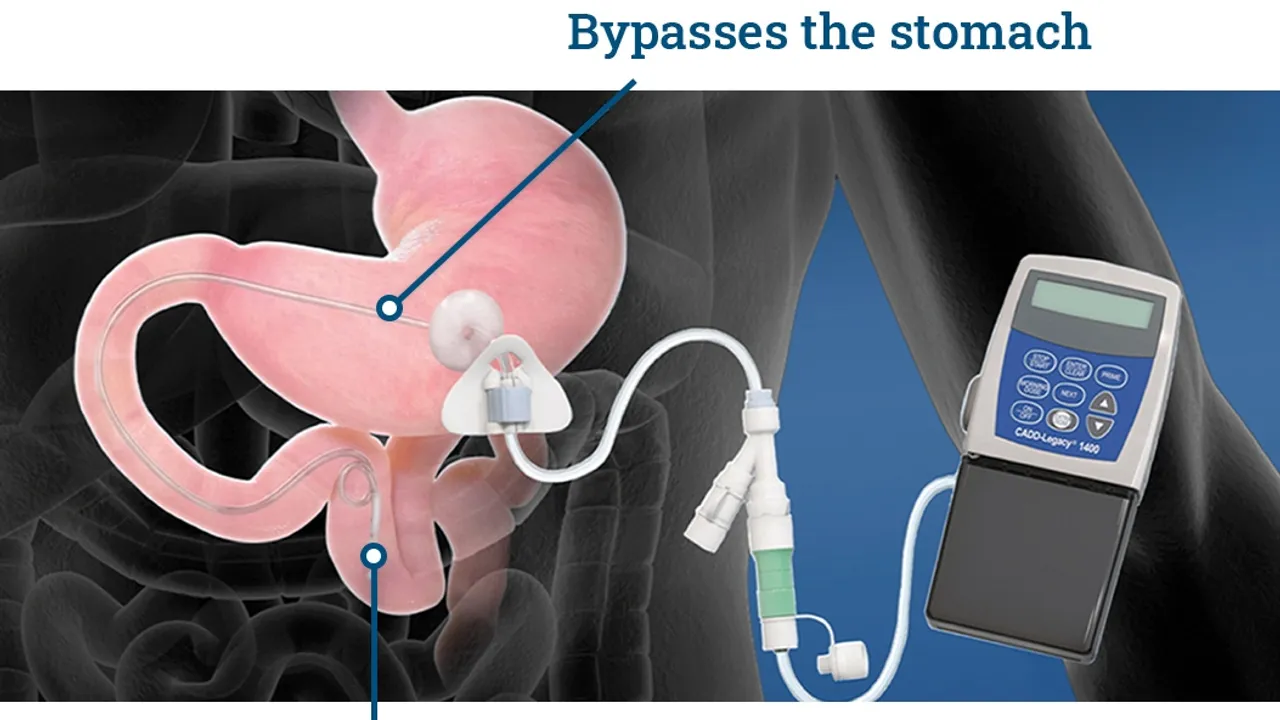 Potsdam Bergmann Clinic Pioneers New Pump Therapy for Parkinson's Patients