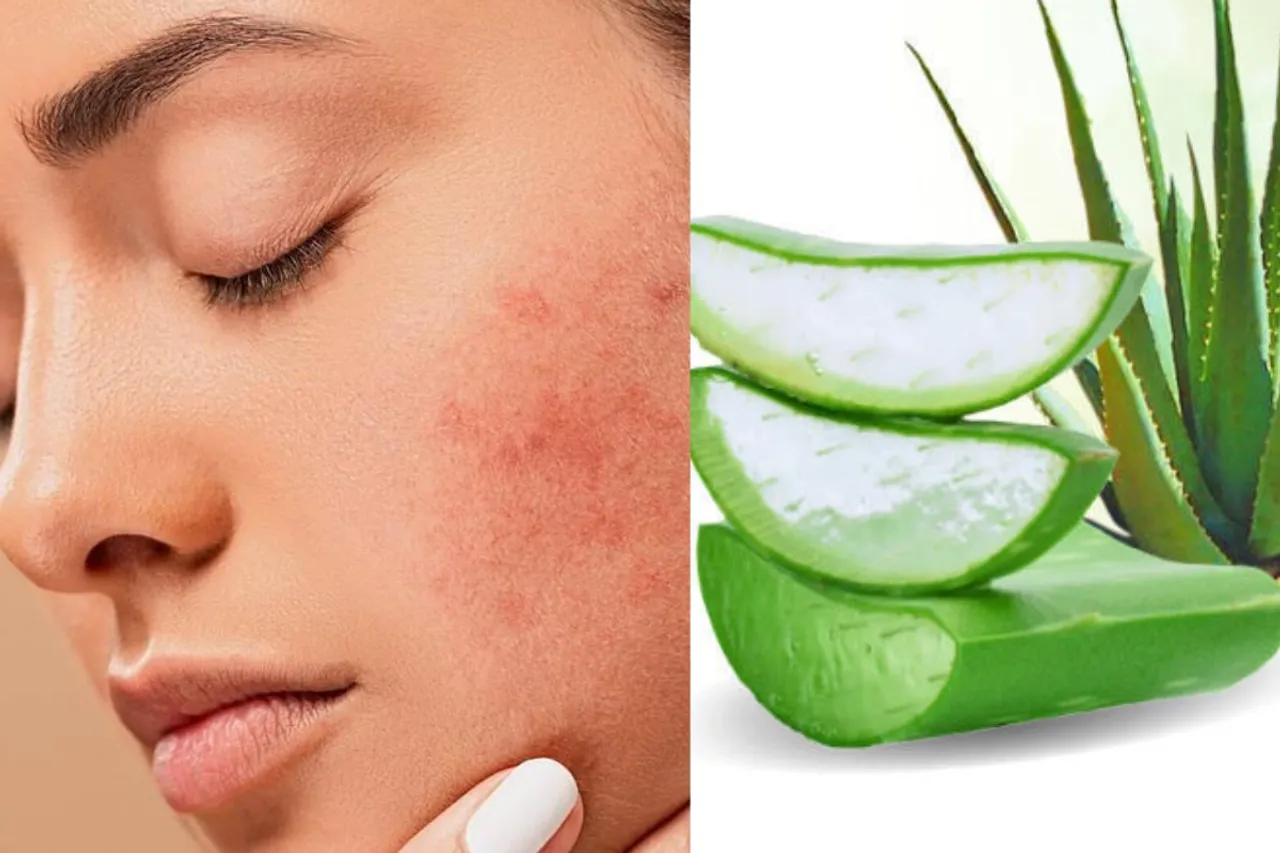 Acne Tips: What is Acne? Best home treatments for removing acne and how ...