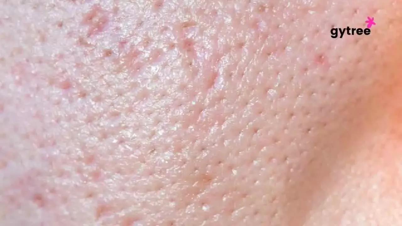 Open pores on face: How to manage them effectively?