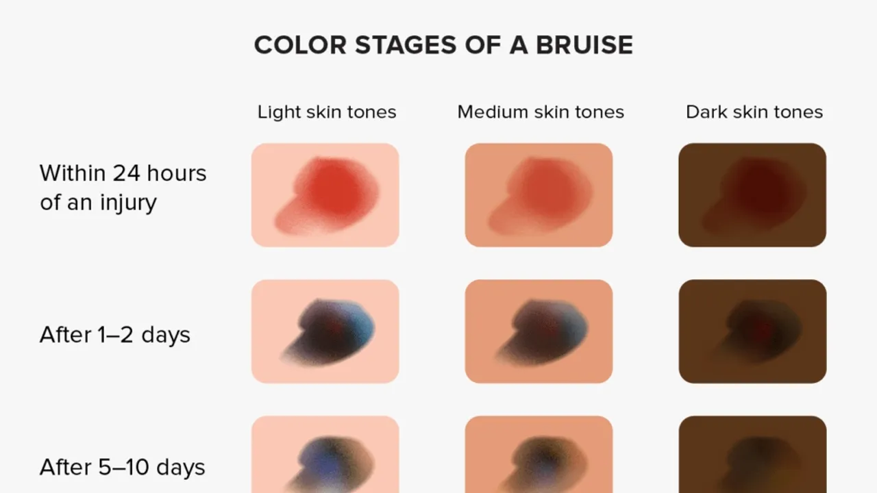 Understanding and Managing Bruises and Black Eyes: Tips and Treatment Options