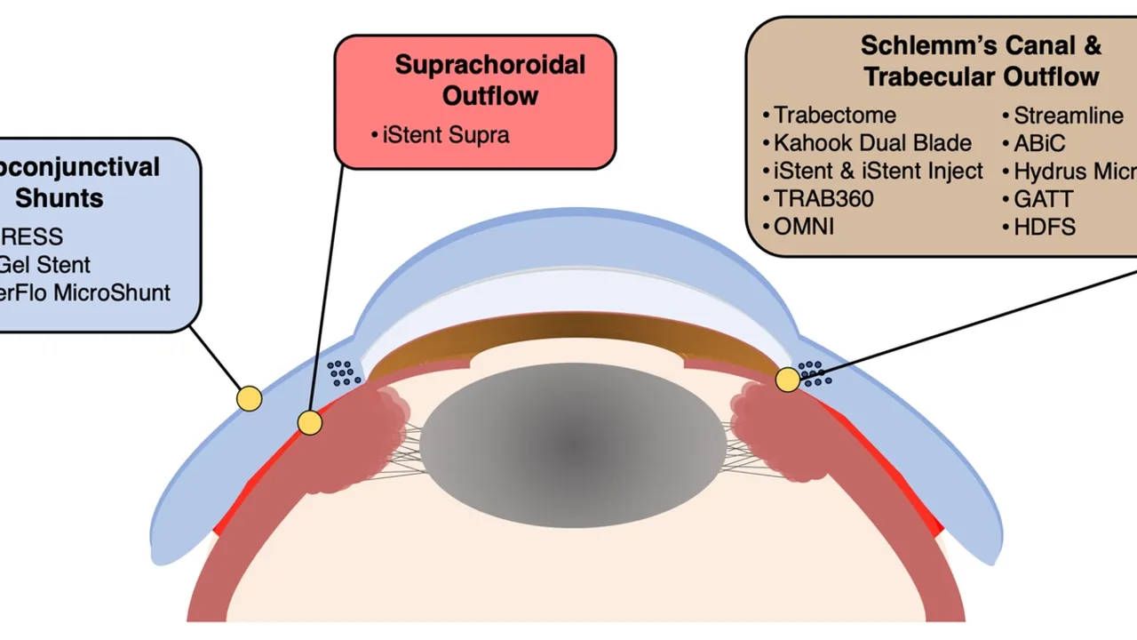Combining Cataract Surgery With Migs A Promising Approach For Glaucoma