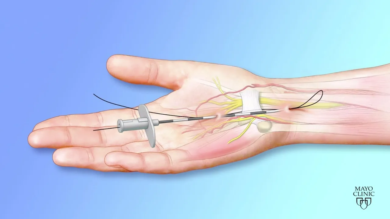 Mayo Clinic Explores Non-Surgical Treatment for Carpal Tunnel Syndrome ...