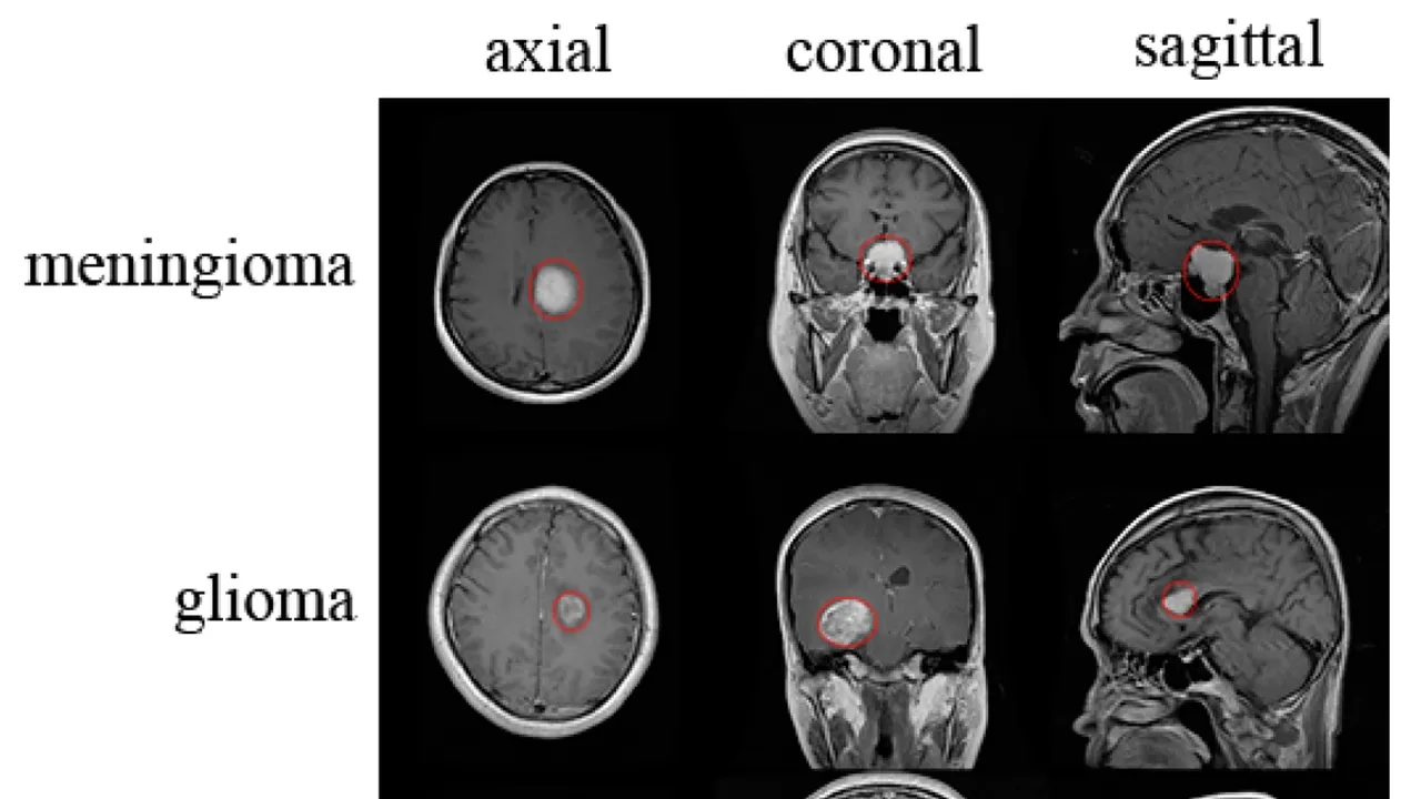 Understanding Meningioma and Glioblastoma: A Deep Dive into Brain Tumors