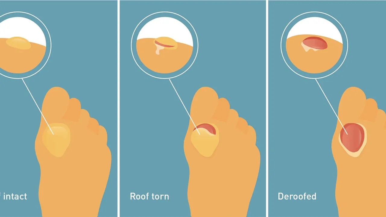 Understanding, Treating and Preventing Blisters