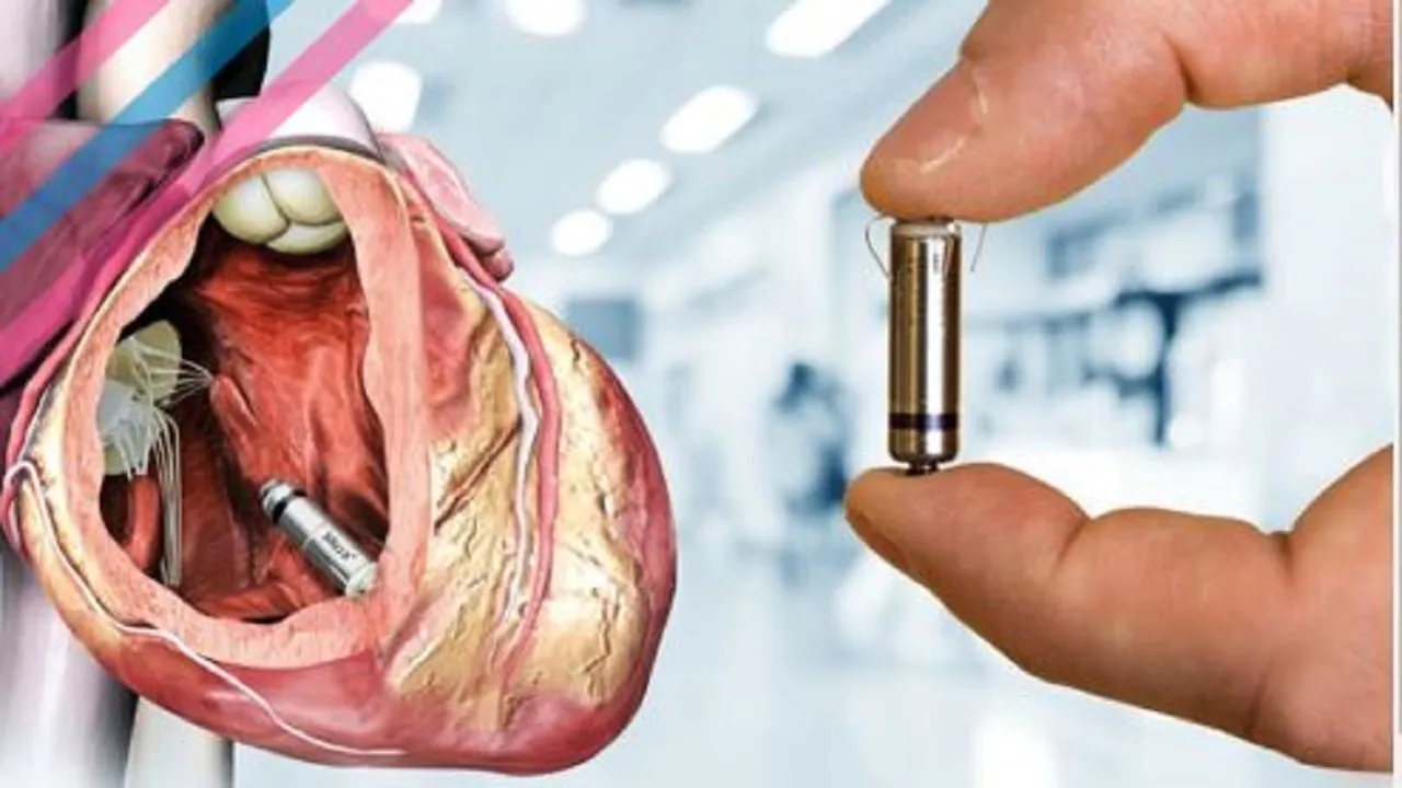 Leadless Pacemaker: क्या है लीडेलेस पेसमेकर? हृदय रोगी बुजुर्ग महिला को ...