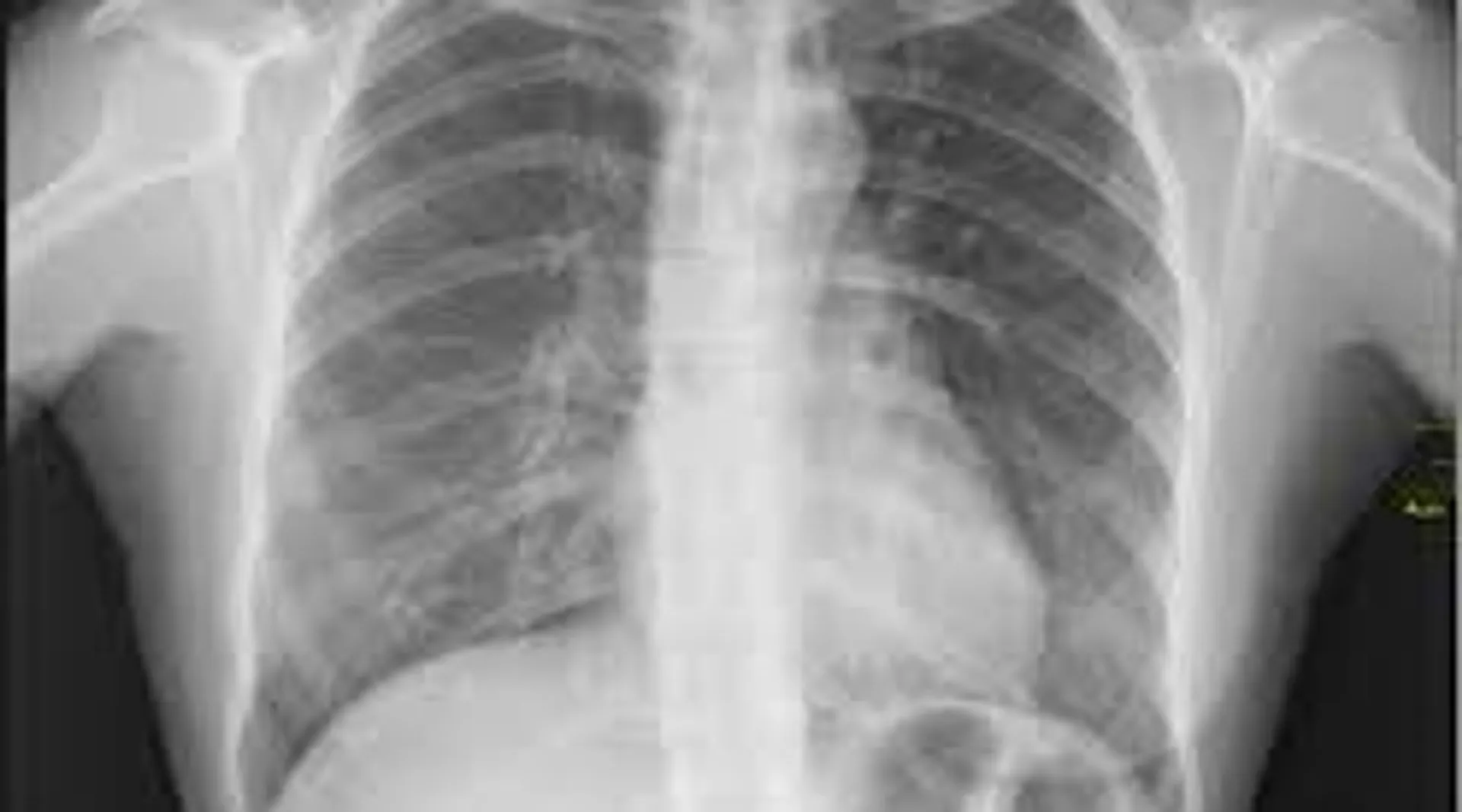 x-ray discovery day News - Latest x-ray discovery day News, Breaking x ...