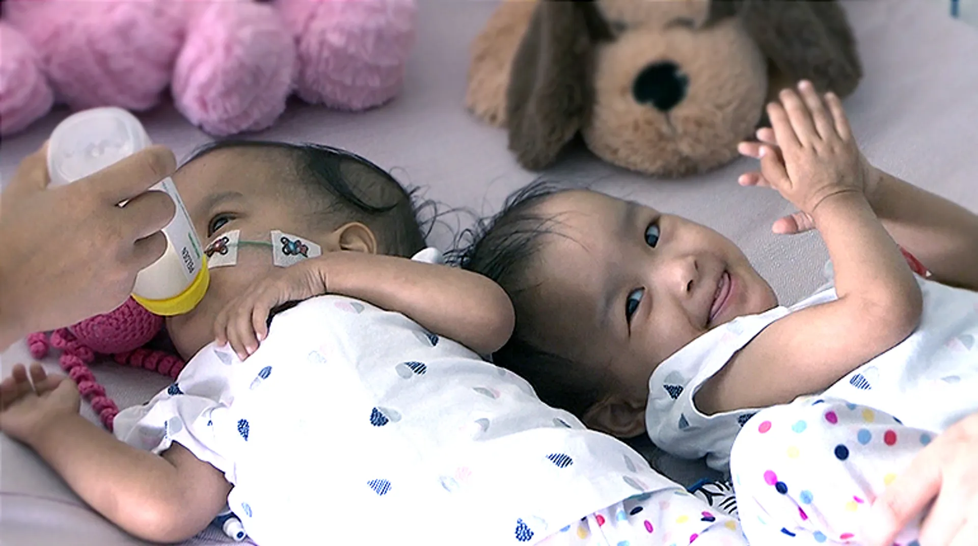 Conjoined twins in Australia News - Latest Conjoined twins in Australia ...