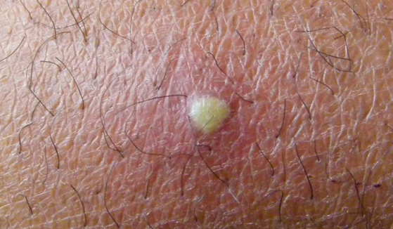 Vulvar Acne: वल्वर मुँहासे को कम करने के लिए टिप्स