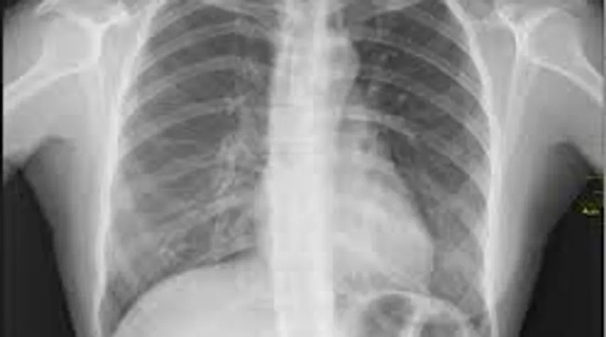 X-Ray anniversary News - Latest X-Ray anniversary News, Breaking X-Ray ...